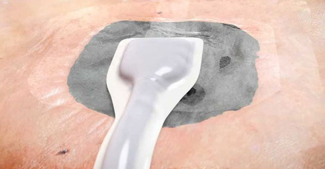 Chronic Wounds: Here's What You Need To Know About Your Wound.